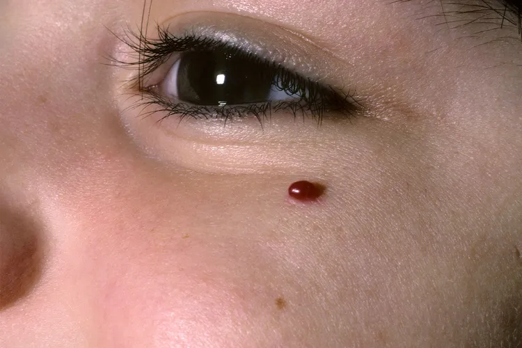 What Is a Pyogenic Granuloma? - IPL Laser Machines